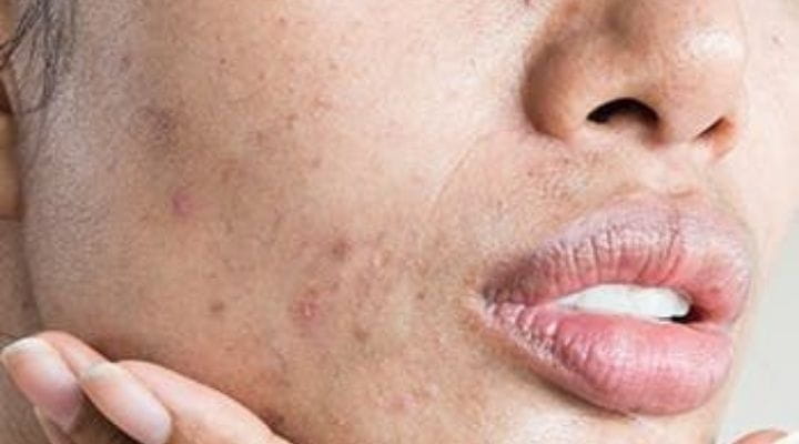 Mapa da acne: significado das espinhas em cada área do rosto