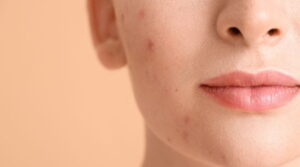 Pele acneica: saiba tudo sobre cuidados, tratamentos e mais