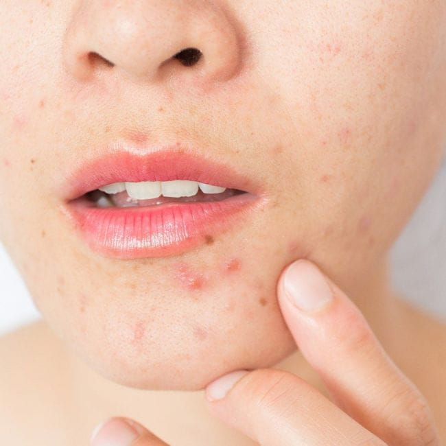 Muitas espinhas no rosto de repente? Causas e como tratar