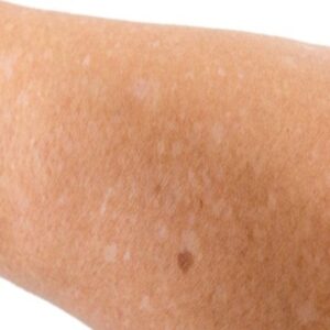 O que são as manchas brancas na pele? Entenda 8 explicações