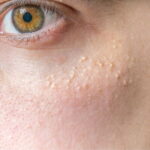 Milium: entenda o que é, quais as causas e como tratá-lo