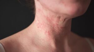 Dermatite Seborreica(caspa): sintomas, causas e tratamentos