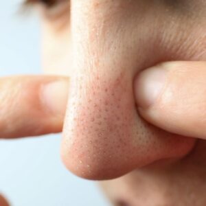 Cravos brancos e pretos: diferenças + como tratar