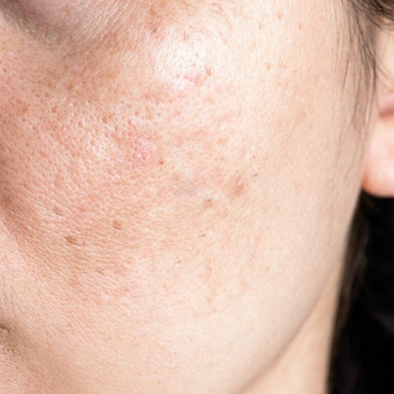 Guia melanose solar: o qué, tratamento e prevenção!