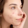 Acne grau 3: sinais, como identificar e tratamento