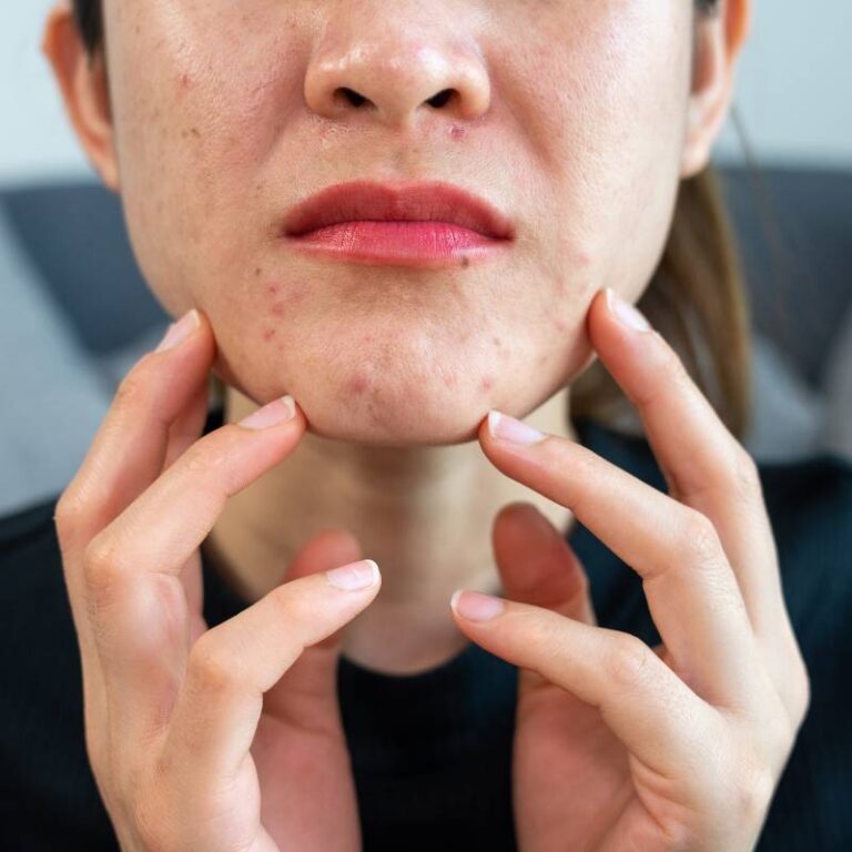 Cicatriz de acne: como se forma? Quais os tratamentos?