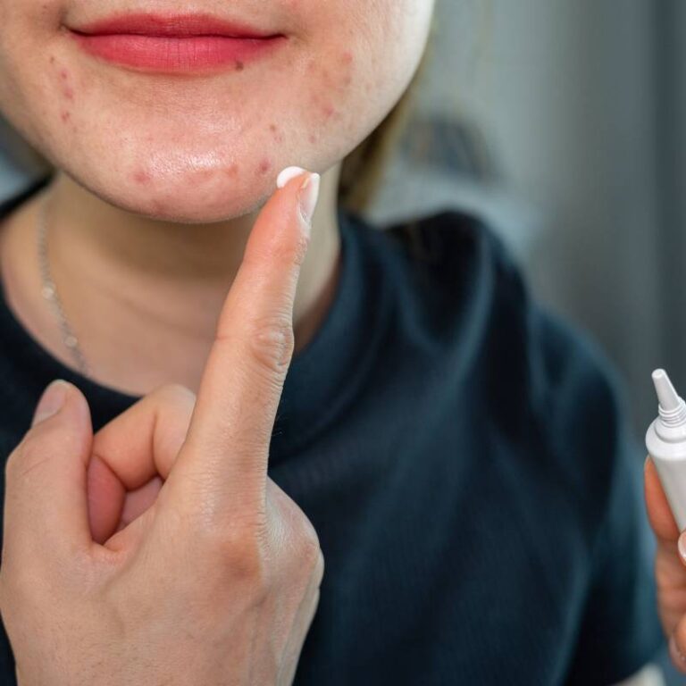 Isotretinoína: o que é, função e tratamentos alternativos