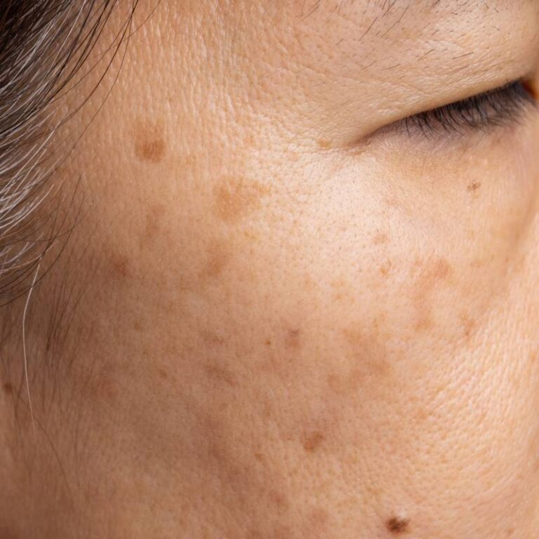 5 tipos de manchas no rosto: identifique a sua agora!
